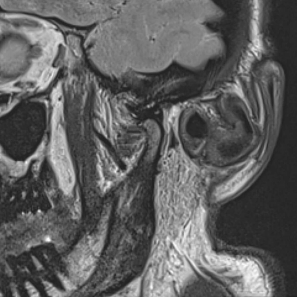 Kiefergelenk MRT Frankfurt – Dr. Behrens & Dr. Schloß